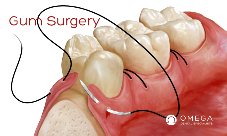 Cost of Alveoloplasty | Omega Dental Houston TX
