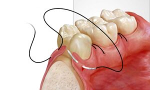 What is Alveoloplasty? | Omega Dental Houston TX