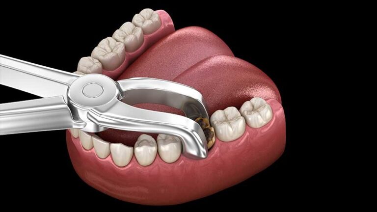 How To Stop Bleeding After Tooth Extraction | Omega Dental