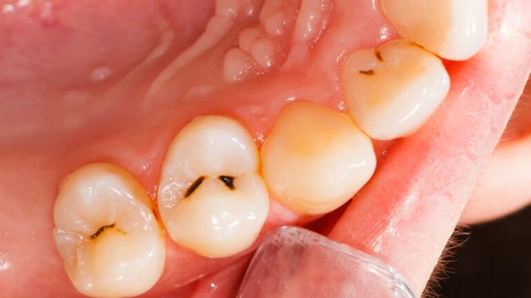 Omega Dental: Rotten Tooth Symptoms & Treatment Guide | Blog