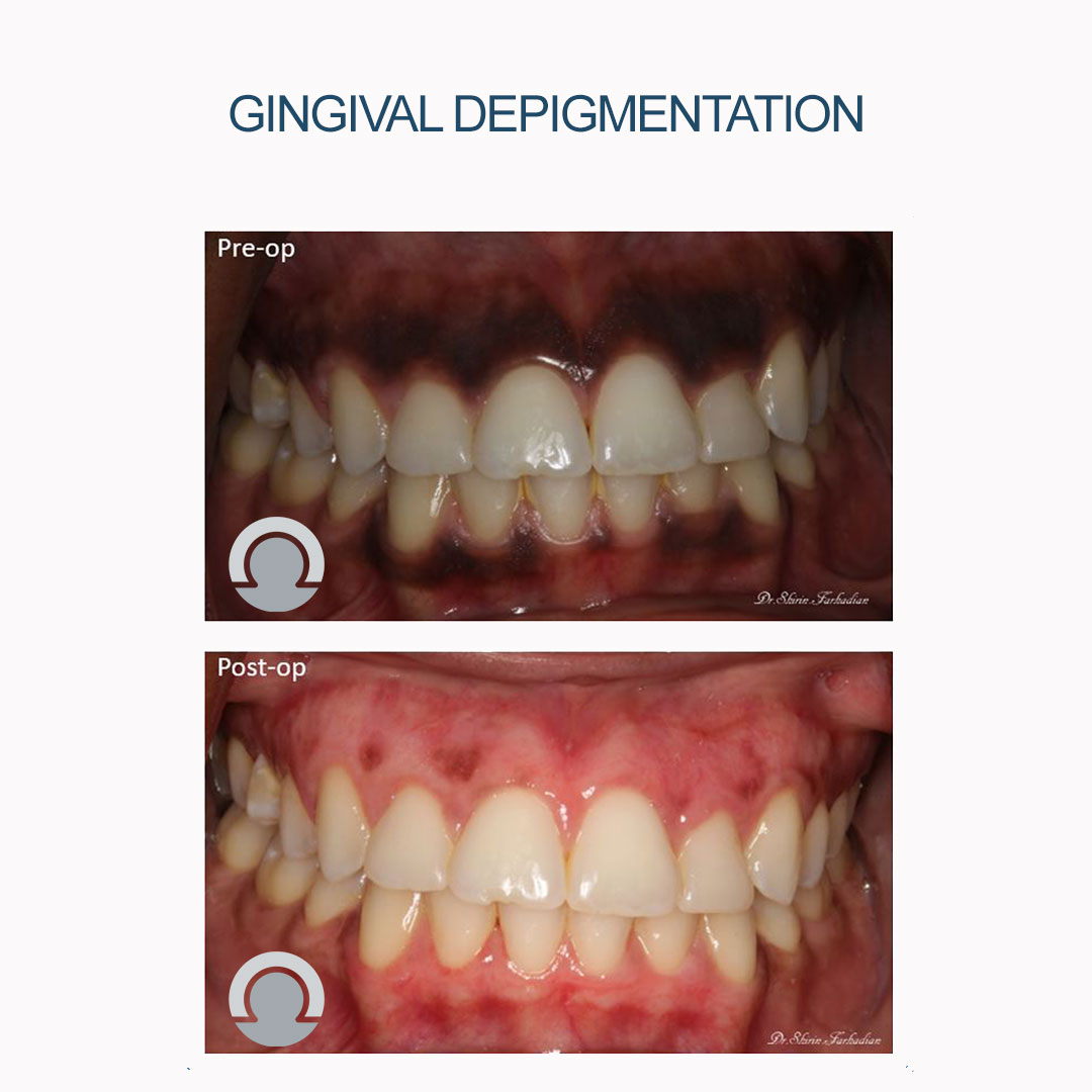 Gingival Depigmentation (Gingival Bleaching) | Omega Dental Houston TX